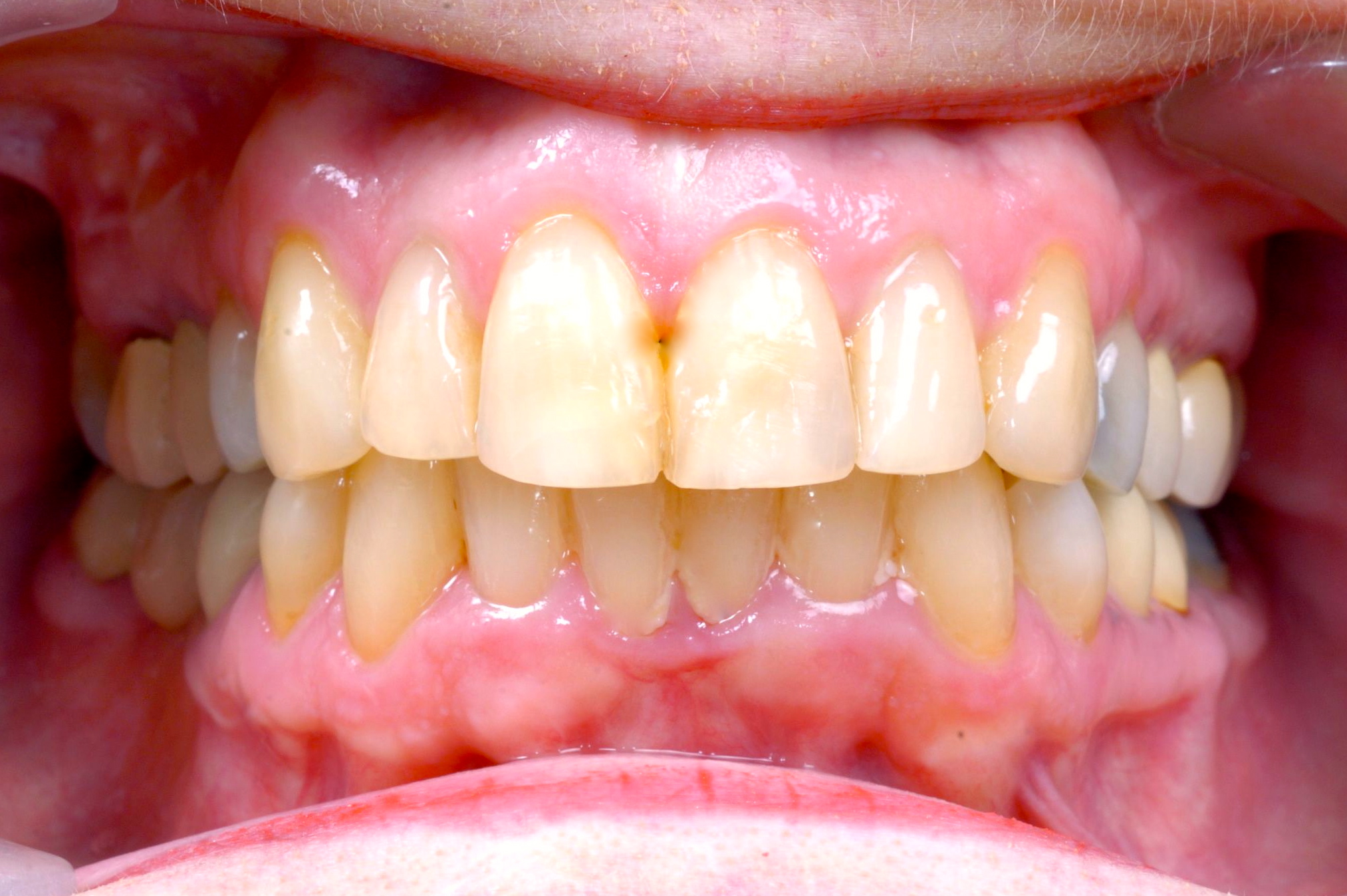 Invisalign onzichtbare beugel– Roelofs Orthodontistenpraktijk