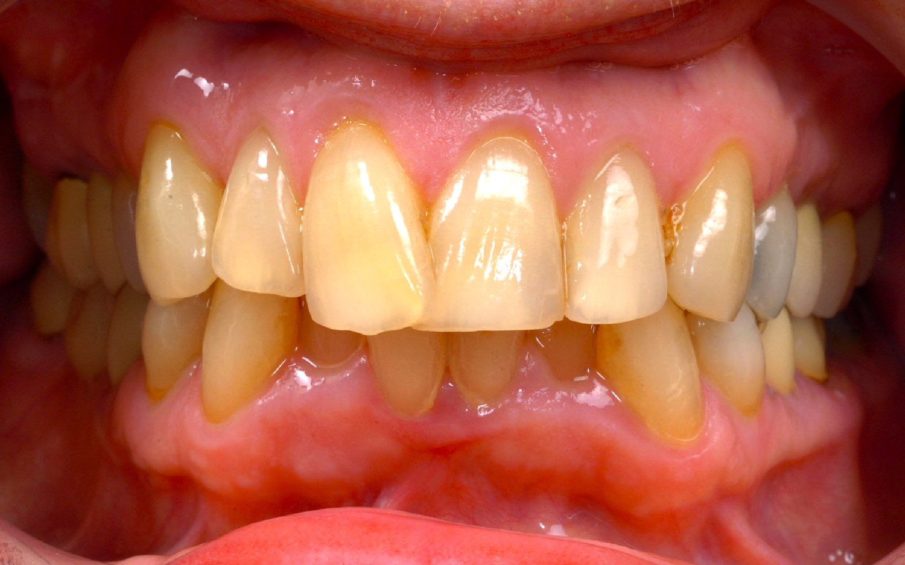 Invisalign onzichtbare beugel– Roelofs Orthodontistenpraktijk