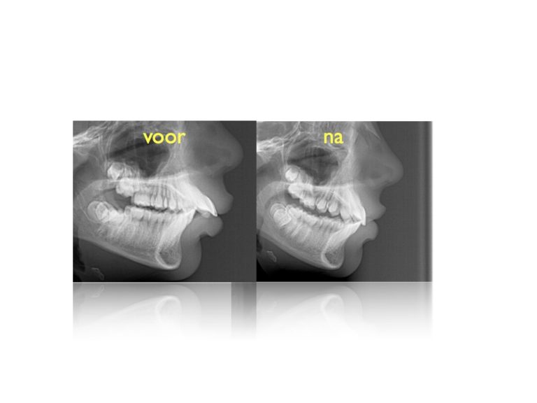 activator behandeling– Roelofs Orthodontistenpraktijk